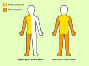 Soorten van cerebrale parese: spastisch, dyskenetisch, atactisch